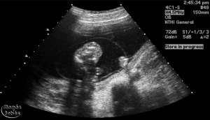 Embarazo Molar - Mamás y Bebés